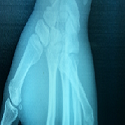 Isolated radial volar dislocation of the fifth carpometacarpal joint: a ...
