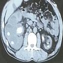 Bilateral kidney matrix stones: a rare case