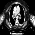 The diagnosis of pulmonary embolism without contrastis not always ...