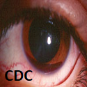 Knowledge, beliefs and practices regarding sickle cell eye disease of ...