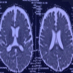 An atypical case of febrile infection-related epilepsy syndrome ...