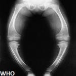 Profils cliniques, biologiques et étiologiques des ostéomalacies