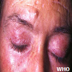 Profil épidémiologique de la dermatomyosite et de la polymyosite ...