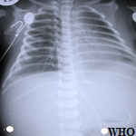 Perinatal tuberculosis: a diagnostic and treatment challenge in a ...