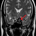 Sellar brain tumour co-existing with a left posterior communicating ...